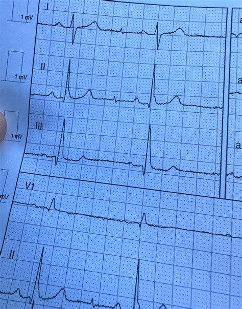 Right Bundle Branch Block Or Normal U Can See It Towards The End R