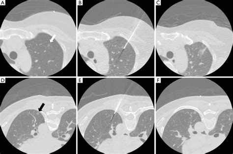 Preoperative Computed Tomography Guided Dye Injection To Localize Multiple Lung Nodules For