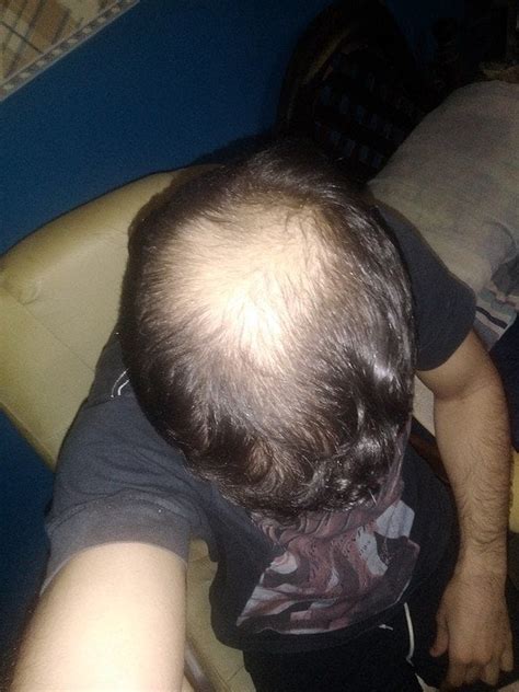 5 Years With Minoxidil Derma Roller Tressless