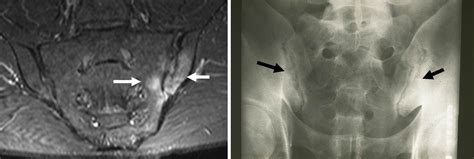 Morbus Bechterew Ursachen Diagnose Therapien Orthinform