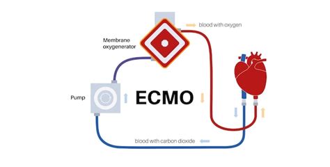 Premium Vector Extracorporeal Membrane Oxygenation