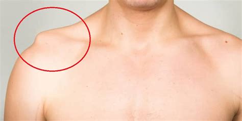 Luxación Acromioclavicular ¿en Qué Consiste • Dr Miguel Romero