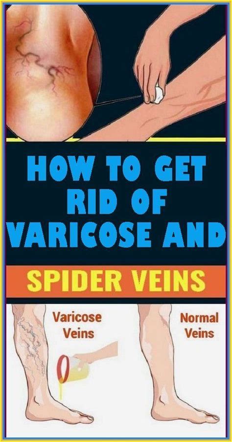 Get Rid Of Varicose Veins Artofit
