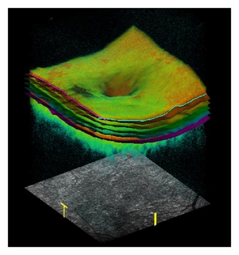 Volume Rendering Of The Macula From The Three Dimensional Sdoct Data