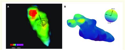 Endocardial Activation Mapping Of Va Stable Va With Earliest