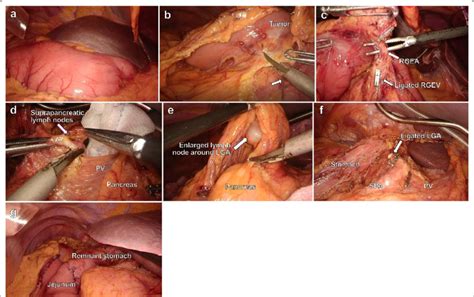 Intraoperative Findings During Laparoscopic Distal Gastrectomy A Download Scientific Diagram