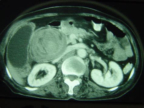 Liver Cholangiohepatitis 2693 Common Bile Duct Intrahepatic Stones 2