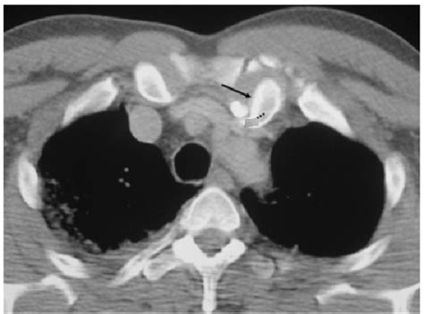 Anatomy 1 Sternoclavicular Joint Dislocation Diagram Quizlet