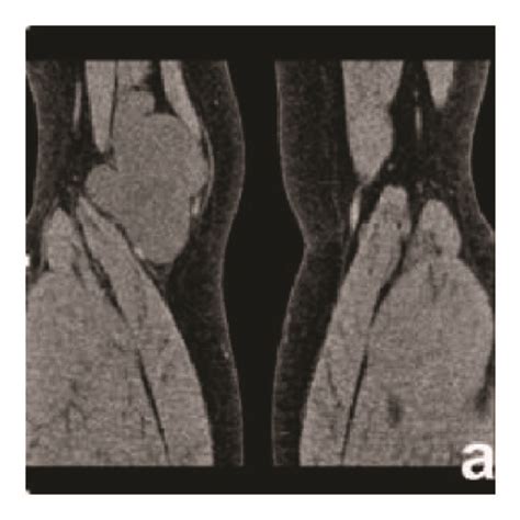 A 47 Year Old Female With Well Differentiated Adult Fibrosarcoma A A Download Scientific