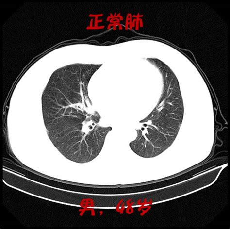 正常肺 正常肝 正常肺片 大山谷图库