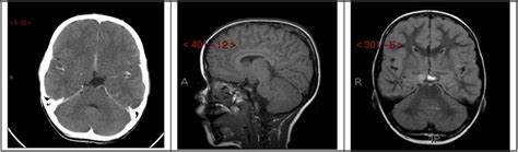 Abc Right Sided Hypothalamic Tumor A Contrast Enhanced Ct Showed