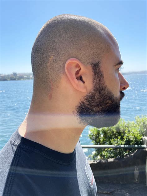 Brain Surgery Scar