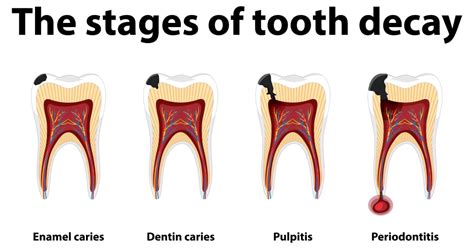 Common Symptoms Of Tooth Decay Smilewide Dental Clinic
