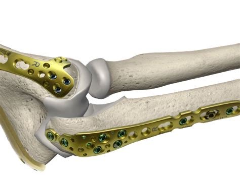 Elbow Plating System Supplier In Navi Mumbai