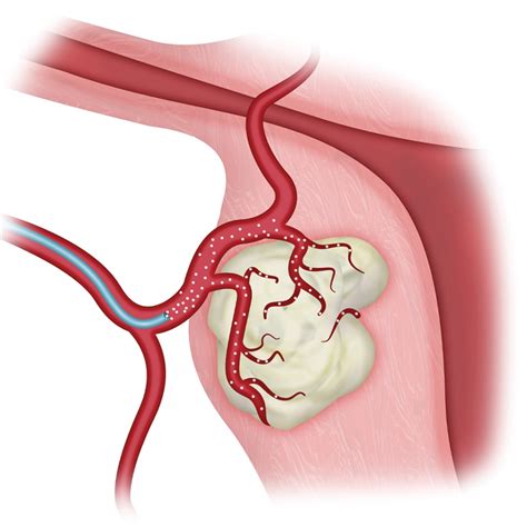 Uterine Fibroid Embolization Ufe Fibroid Treatment In Mn