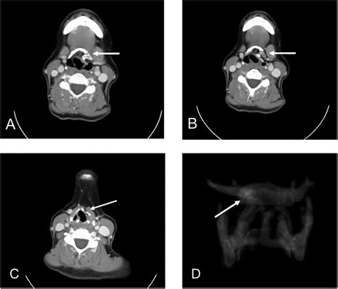 Preoperative Ct Imaging A C Preoperative Axial Ct Scans Showing The