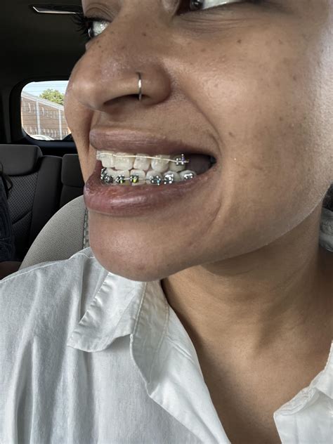 Did Braces Affect Your Fellatio Game Rbraces