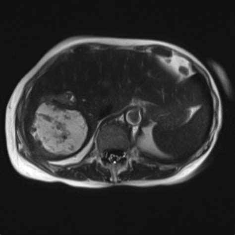T2w Magnetic Resonance Imaging Of The Liver Demonstrating High Signal Download Scientific
