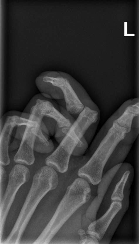 Locking Pip Joint At Luca Schonell Blog