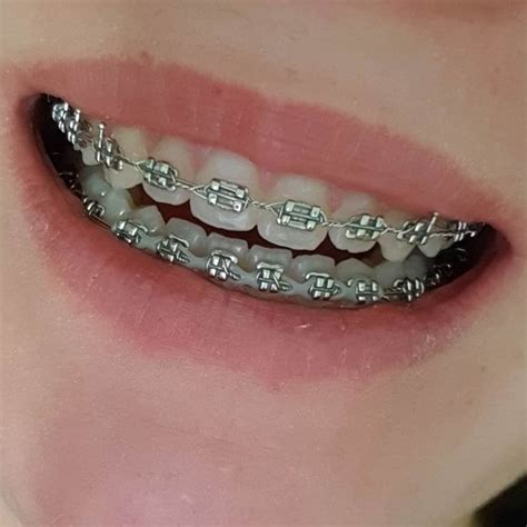 Pin By Krisss On Brakets 😻 Perfect Teeth Braces Perfect Teeth