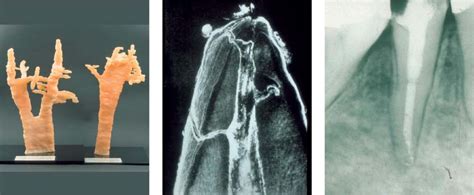 25 Root Canal Disinfection Pocket Dentistry