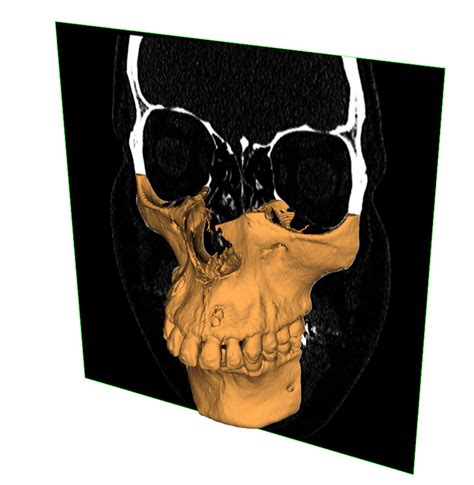 generation of 3d model of mandible from dicom data freelancer