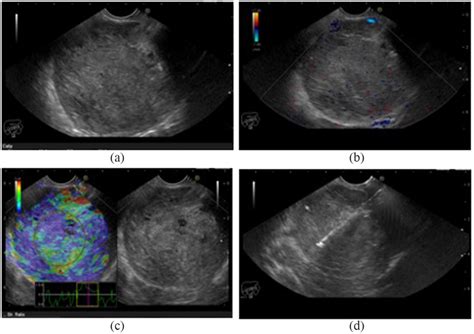 Eus Examination Of A Pancreatic Head Mass A Large Isoechoic