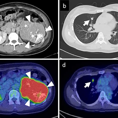 Figure1a B Contrast Enhanced Computed Tomography Ct Showing A