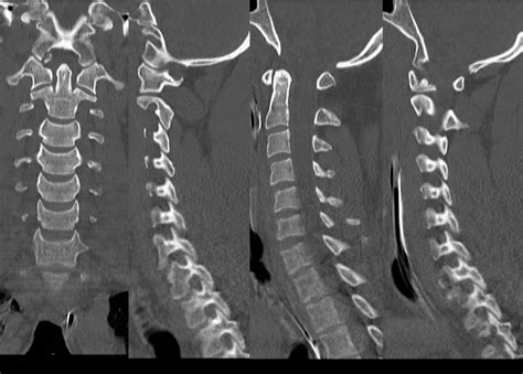 L1 Burst Fracture With Distractions At T12 L1 And C6 7
