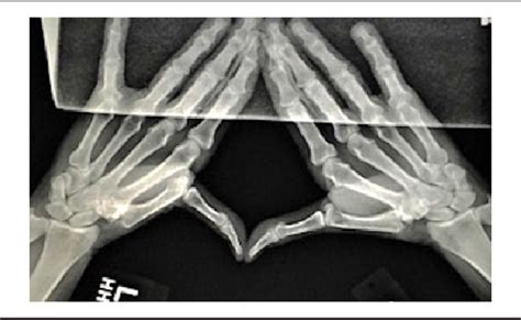 Figure 4 From Diamond Stress View Radiograph For Thumb Metacarpophalangeal Hyperextension