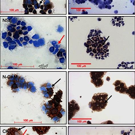 Neuroendocrine And Epithelial Markers In The Sclc Dms 79 Cell Line