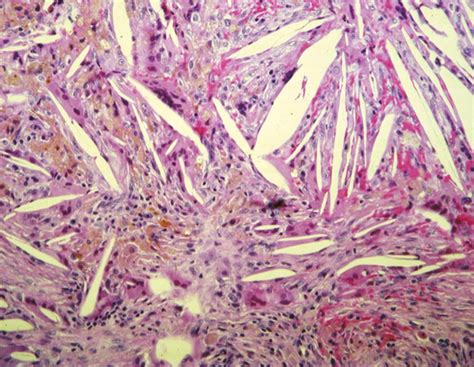 Cholesterol Granulomas And Congenital Epidermoid Tumors Of The Temporal