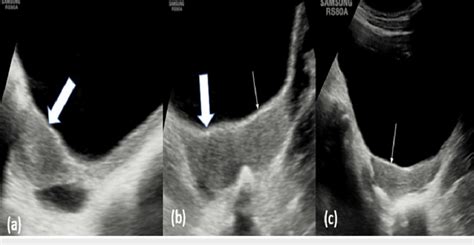 USG Pelvis Images A Axial Section Showing A Noncommunicating
