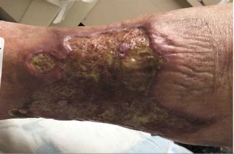Pyoderma Gangrenosum In Primary Care Setting The Challenges Involved Pmc