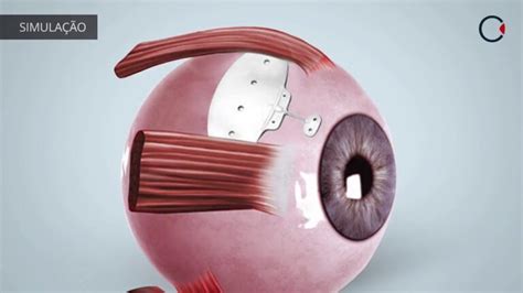 Cirurgia Ocular Tratamento Eficiente Para Glaucoma Actualizado Abril