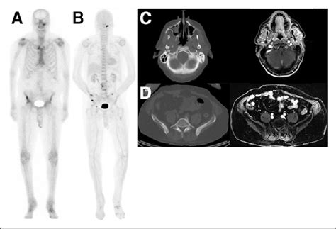 A 70 Y Old Man With Prostate Cancer A And B Planar Whole Body