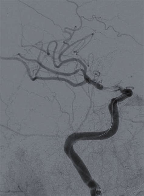 Dsa Image Of Acute Right Mca M1 Occlusion And Partial Recanalization Of