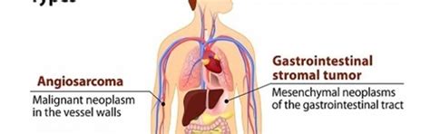 Cinsarc Complexity Index In Sarcomas