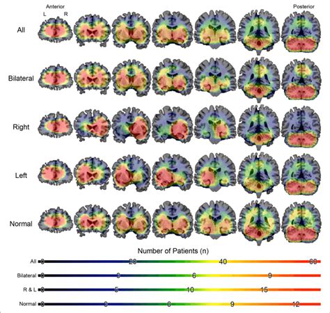 Overlap Maps Of The Localization Of Interictal Epileptiform