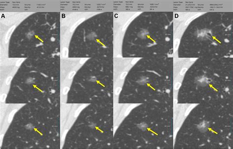 Lung Nodule Management In Low Dose Ct Screening For Lung Cancer Lessons From The Nelson Trial