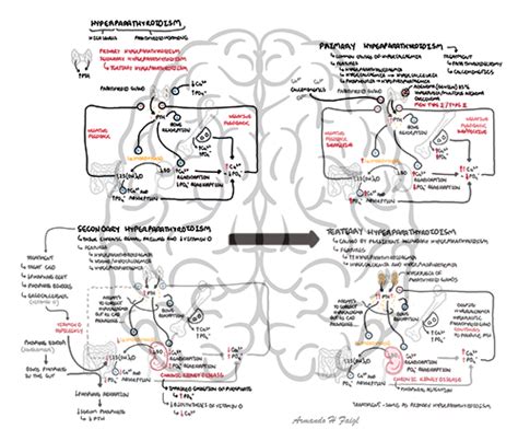 Hyperparathyroidism Personal Use Armando Hasudungan