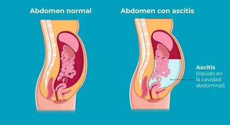 Ascitis Causas Síntomas Y Tratamiento Gastro Sb