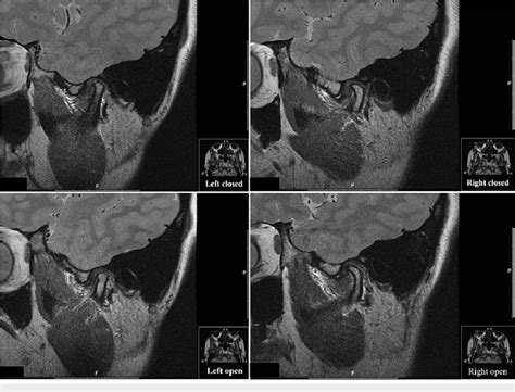 Magnetic Resonance Imaging Of The Left And Right Tmj Temporal Fossa Download Scientific Diagram