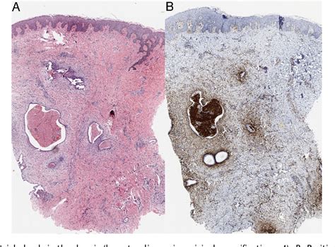 Figure 1 From Spontaneous Primary Umbilical Endometriosis With