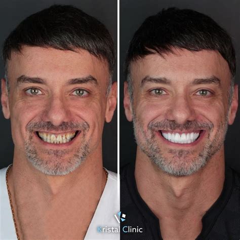 Hollywood Smile Before And After E Max Crowns