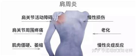 【锐博康复科普】【肩周炎五十肩】自测全阶段康复训练 知乎