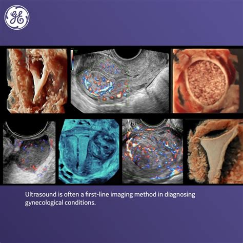 Ge Healthcare Voluson Ultrasound On Linkedin Gynecology Ultrasound Voluson Gehc