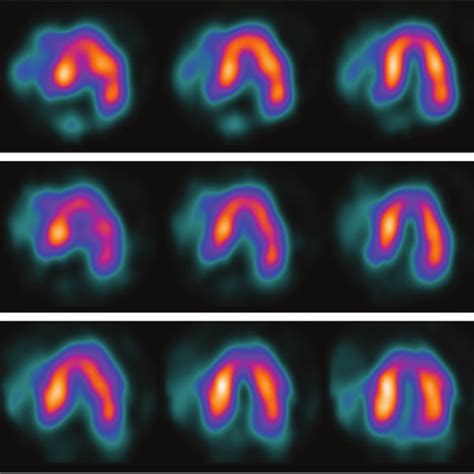 Pdf Deep Learning Guided Attenuation Correction In The Image Domain For Myocardial Perfusion