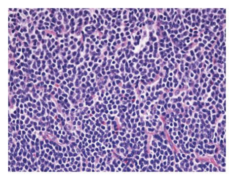 H E Sections Of The Lymph Node Excisional Biopsy Before Transformation Download Scientific