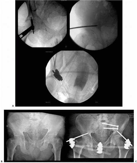 Principles Of External Fixation Teachme Orthopedics